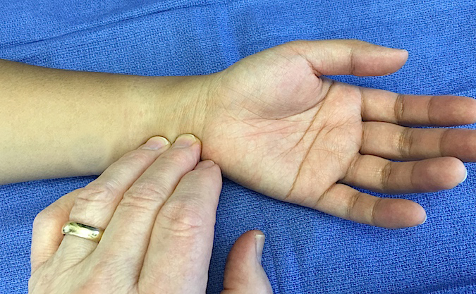 Ulnar Artery Pulse | Hand Surgery Resource